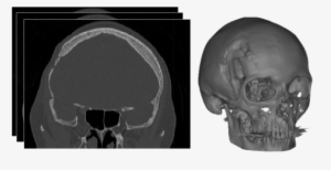 Ct-scan Segmentation & 3d Reconstruction - Ct Scan Transparent ...