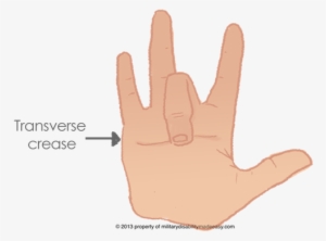 Limitation Of Motion Of The Fingers - Sign - 493x365 PNG Download - PNGkit
