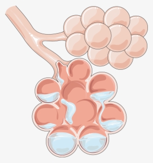 Pulmonary Edema Servier Medical Art Free Images - Pulmonary Edema ...