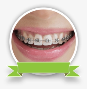 Braces - Dental Braces - 402x415 PNG Download - PNGkit