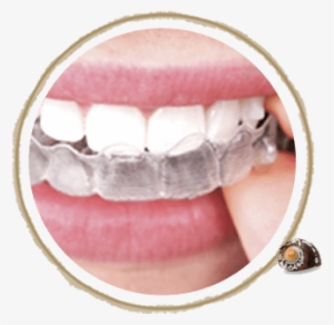 Types Of Braces - Invisible Braces - 367x327 PNG Download - PNGkit