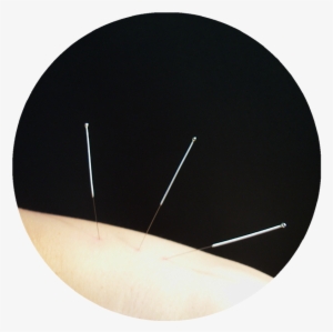 Acupuncture Is The Insertion Of Fine, Single-use Needles - Circle ...