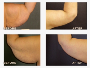 Brachioplasty And Liposuction - Bodybuilding - 502x249 PNG Download ...