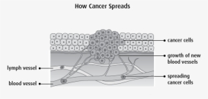 Diagram Of How Cancer Spreads - Comment Le Cancer Se Developpe ...