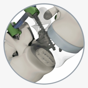 Spinal Spacer System - Novel - 600x600 PNG Download - PNGkit