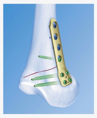 Tomofix Medial Distal Femur Plate - 838x606 PNG Download - PNGkit