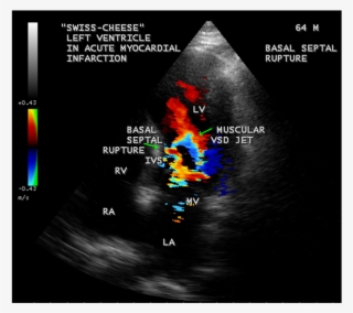 Apical Four Chamber View Showing The Basal Septal Rupture - Muscular ...
