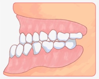 Mouth With A Protruding Lower Lip And Jaw - Prognathism - 640x508 PNG ...
