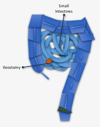 Loop Ileostomy Is A Temporary Diversion Of Stool Out - Ileostomy ...