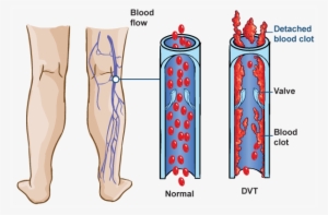 Deep Vein Thrombosis Is The Formation Of A Blood Clot - Dvt Location In ...