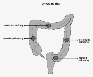 Image Free Colostomy And Ileostomy Canadian Society - Transverse End ...