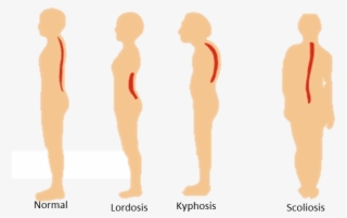 Kyphosis Kyphosis Is The Excessive Outward Curvature - Kyphosis Vs ...