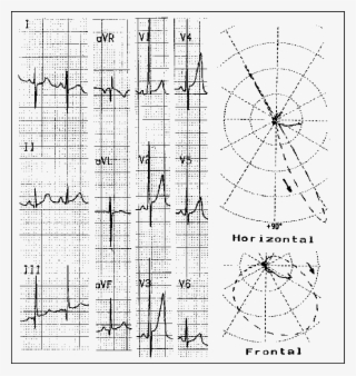 Electro And Vectorcardiogram Revealing Right Ventricular - Diagram ...