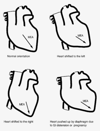 Demonstration Of How The Position Of The Heart In The - Line Art ...